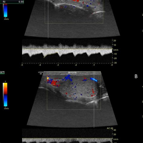 Pulse Wave Doppler Parameters Measured On The Supratesticular A And