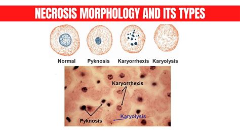 What Is The Morphology Of Necrosis Tjjvcb