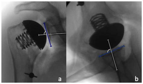 Measurements Of Theoretical Glenoid Component Inclination A And