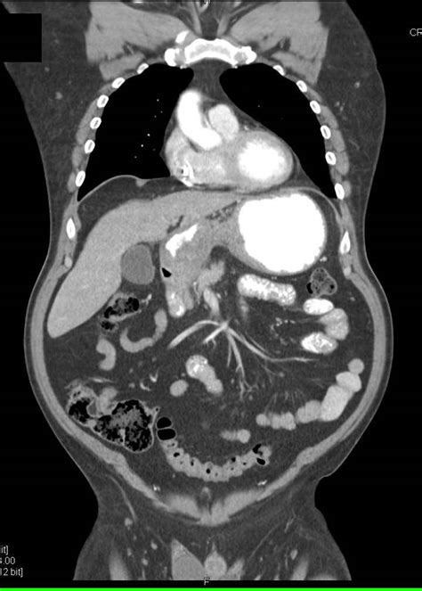 Gastric Carcinoma With Infiltrating Gastric Carcinoma In Antrum