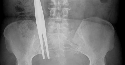 Hundreds Of Patients Have Suffered Major Surgical Blunders Figures