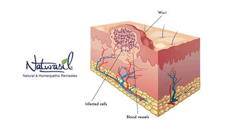 Plantar Warts Causes Symptoms And How To Identify Them Naturasil