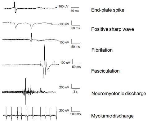 Overview Of The Application Of Emg Recording In The Diagnosis And