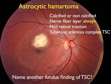 Tuberous Sclerosis Eye