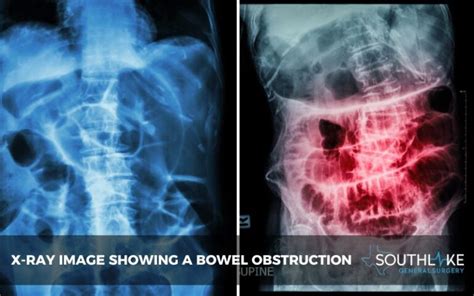 Bowel Blockage Operation Symptoms Causes And Treatment Guide Southlake General Surgery