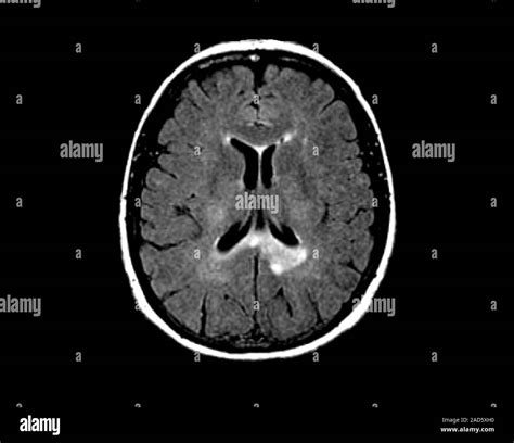Multiple Sclerosis Axial Magnetic Resonance Imaging Mri Scan Of The