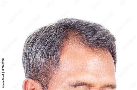 Hair Loss And Grey Hair Male Head With Hair Loss Symptoms Front Stock