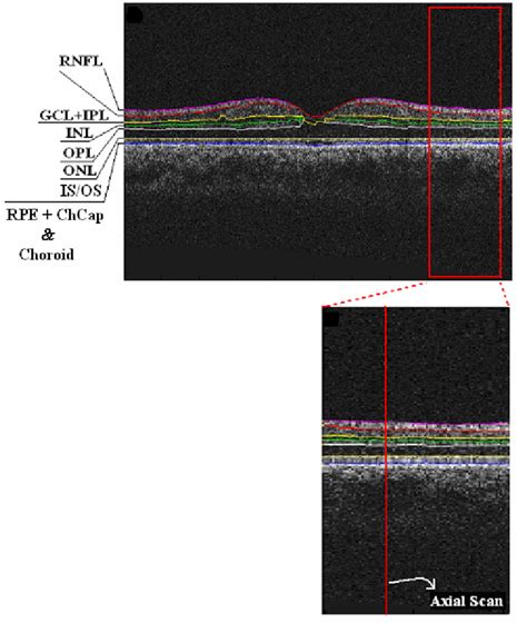 automated segmentation results top original oct image with overlaid