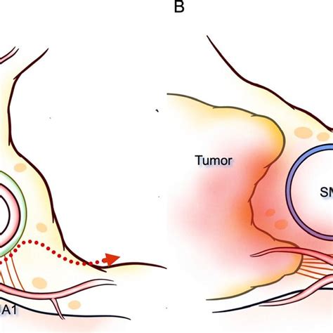 Schematic Representation Of Mesopancreas And Mesocolon Dissection And Download Scientific