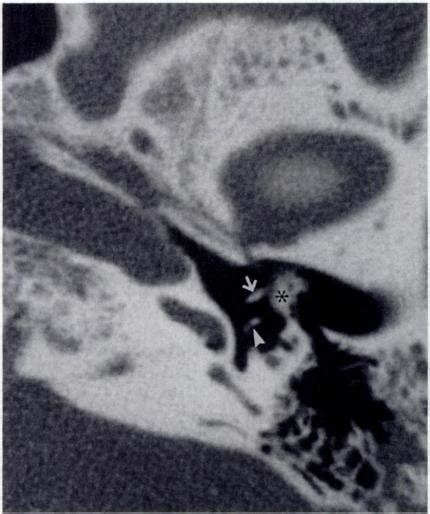 Dislocation Of The Malleoincudal Complex Of The Left Ear A Axial Ct