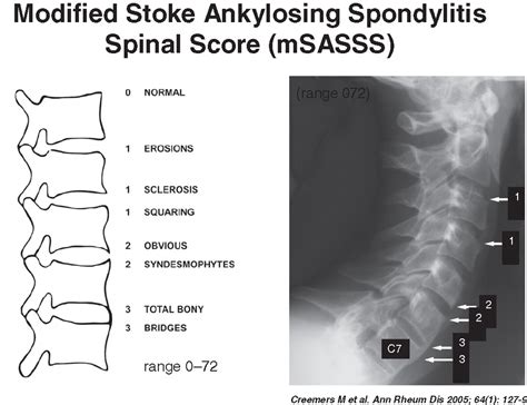 Ankylosing Spondylitis X Ray