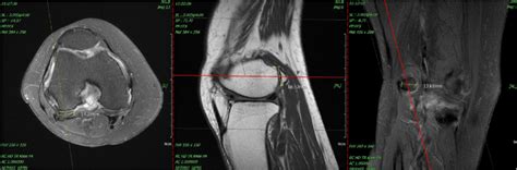The Right Knee Mri Showed A Large Fabella Bone With Subchondral Bone