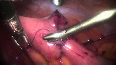 Laparoscopic Ileovesicostomy Mitrofanoff Procedure Youtube