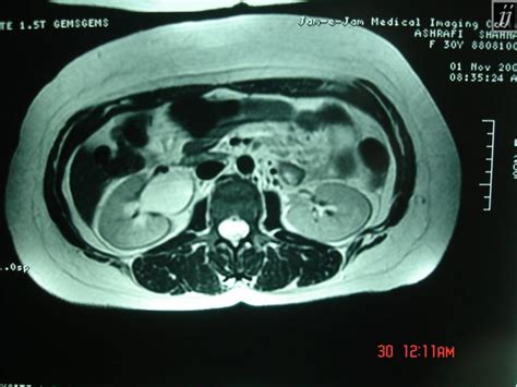Abdomen Right Extra Renal Pelvis Radioogle