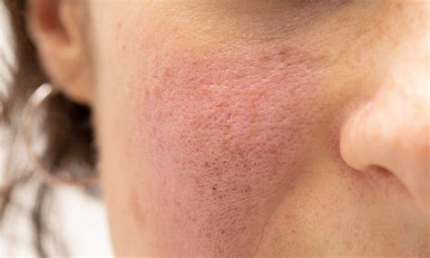 Manchas Rojas En La Piel Causas Y Remedios Eucerin