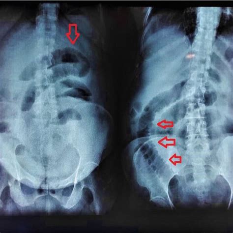 Multiple Diverticula Of Jejunum With Part Of Dilated Jejunum
