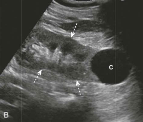 Renal Adrenal Bladder Patho Exam Flashcards Quizlet
