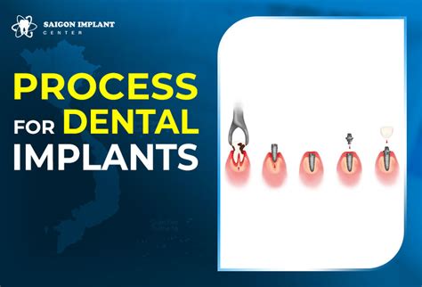 The Complete Process For Dental Implants Saigon Implant Center
