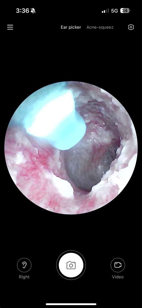 Fungal Ear Infection Raskdoctorsmeeee