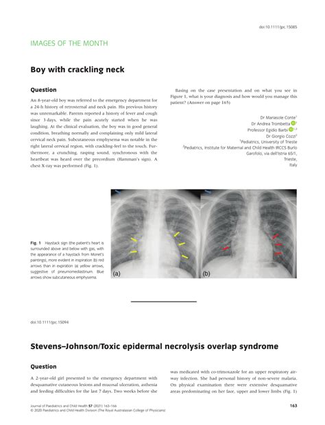 Pdf Stevensjohnsontoxic Epidermal Necrolysis Overlap Syndrome