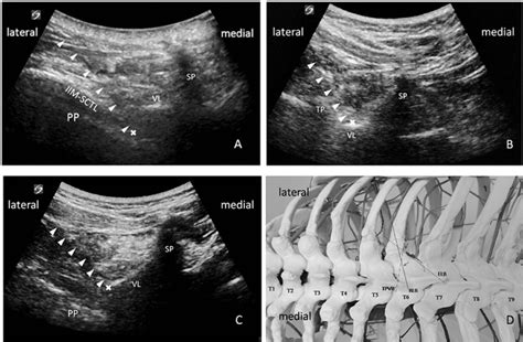 Ultrasound Guided Images And Demonstration Figure A The Image Of Download Scientific Diagram