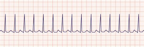 Ecg Interpretation For Nclex Part Three The Nurse Speak