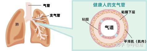 一文区分哮喘和慢性阻塞性肺病的区别 知乎