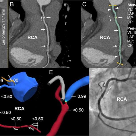 Case 2 The Dotted Line Arrowhead And Arrow Indicate Stenotic Lesion
