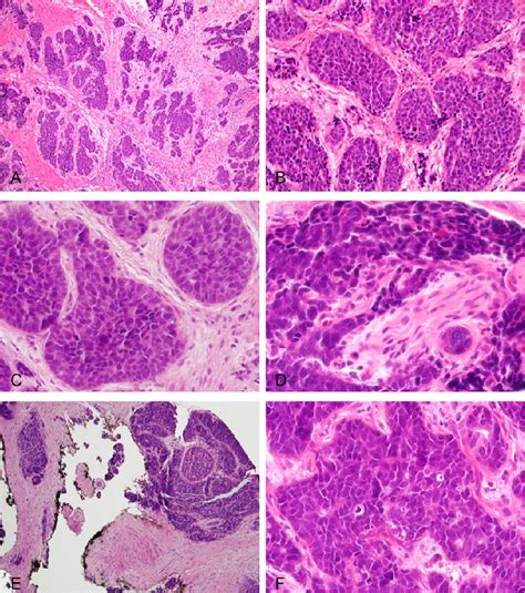 Figure 1 From Solid Variant Of Adenoid Cystic Carcinoma Semantic Scholar