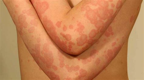 Erythema Multiforme What Is Erythema Multiforme