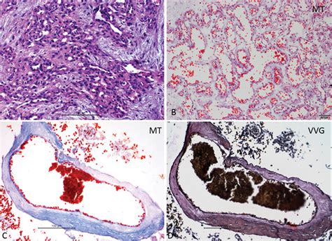 Capillary Hemangioma Composed Of Closely Packed Capillary Sized