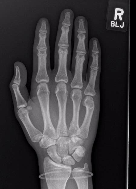 Dorsally Displaced Metacarpal Dislocation Fracture Jetem