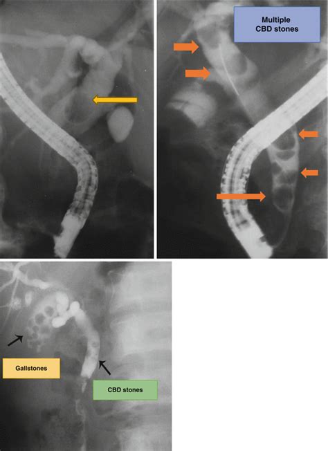 Hepatobiliary Complications Of Sickle Cell Anemia Oncohema Key