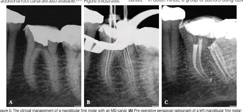 Figure 3 From Root And Canal Morphology Of The Mandibular First Molar A Micro Computed
