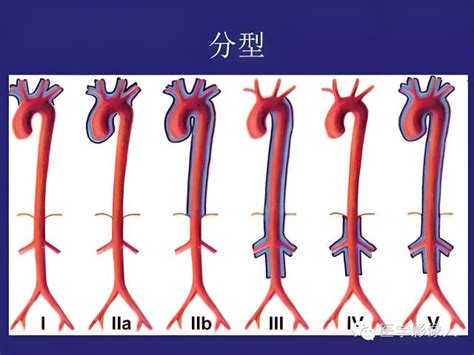 大动脉炎，一种独特的 东方美女病”！
