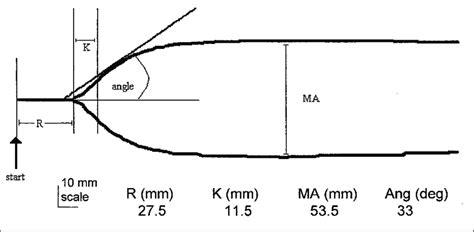 Thromboelastographic Teg Tracing Obtained From Analysis Of A Blood