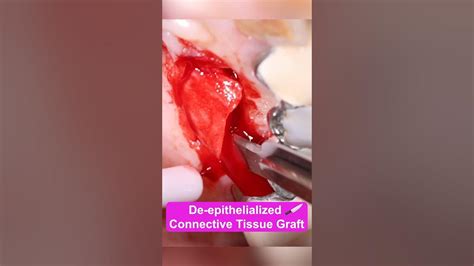 De Epithelialized Connective Tissue Graft Dentalimplants