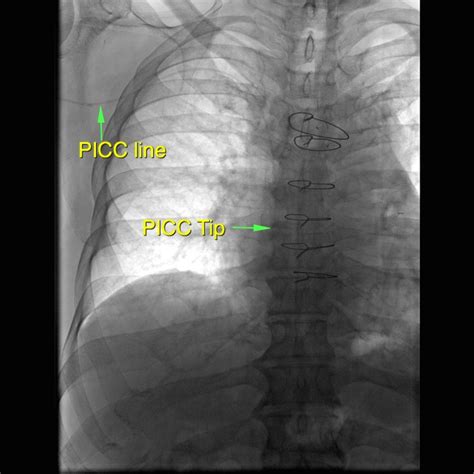 Picc Line Sydney Medical Interventions