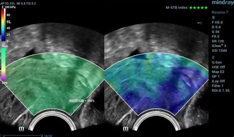 Two Dimensional Shear Wave Elastography Image Under Strict Quality