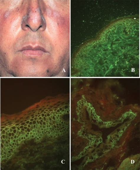 Analysis Of The Reactivity Of Indirect Immunofluorescence In Patients