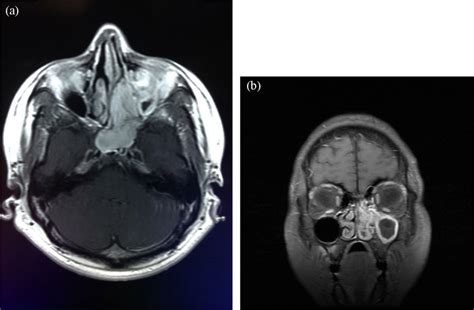 A Axial Contrast Enhanced Mr T1 Weighted Image Demonstrates An