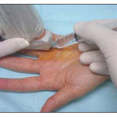 Lidocaine Injection Technique With Dry Needling Using Ultrasound