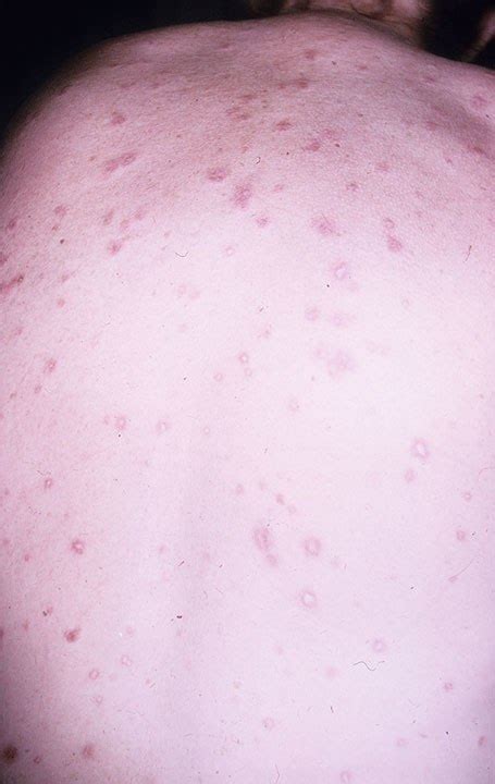 Degos Disease Wikiwand