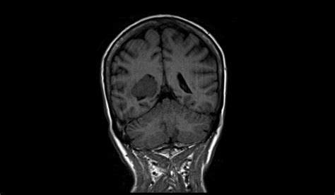 Choroid Plexus Papilloma Cpp Mri Radiology Article On Choroid