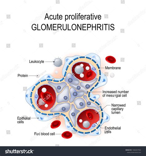 Acute Proliferative Glomerulonephritis Disorder Glomeruli Small Stock Illustration 1360267592