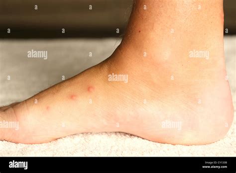 Identifying Bug Bites On Humans