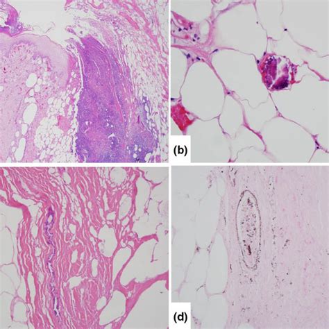 Initial Clinical Evaluation Of The Breast Lesions A Right Breast
