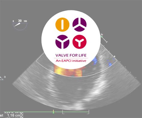Teer For Mitral And Tricuspid Regurgitation Valve For Life Uk