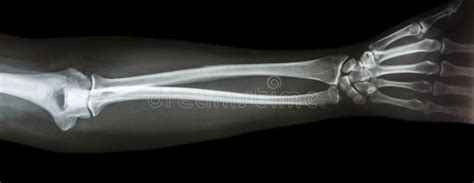 Antebrazo Ap De La Radiografía De La Película Anteroposterior Imagen