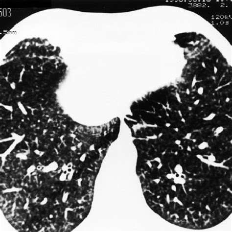 Case Chest X Ray And CT Showing Diffuse And Bilateral Micronodular Download Scientific